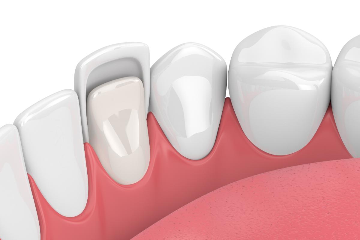 Benefits Of Dental Veneers Cosmetic Dentistry Services Tx